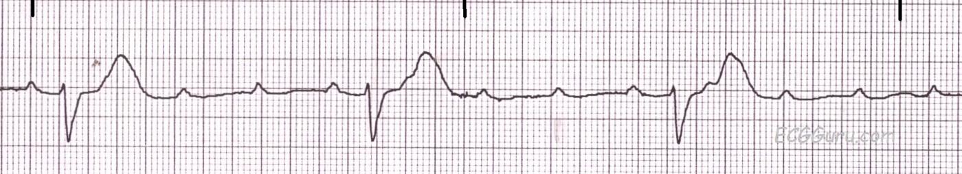 ECG Basics: Third-degree AV Block, Complete Heart Block | ECG Guru ... ECG Basics: Third-degree AV Block, Complete Heart Block | ECG Guru ...